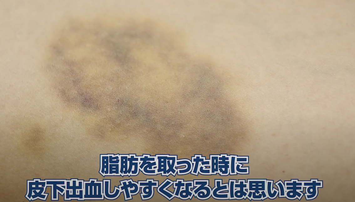 幹細胞治療でお腹の脂肪採取をする当日の注意事項 お茶の水セルクリニック